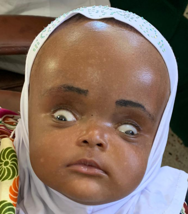 Ophthalmology Notes: ASTRONOMICAL NOMENCLATURE IN OPHTHALMOLOGY