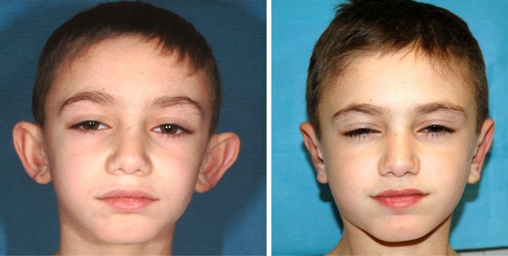 ¿QUÉ ES LA OTOPLASTIA? | INFO CIRUGÍA ESTÉTICA