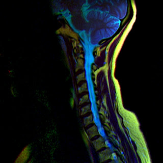 Nevit's blog: Cervical spine Color MRI
