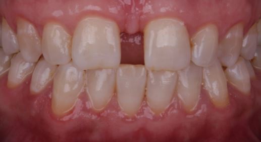 Causes of Open bite, Deep bite, crowding, Generalized spacing, Midline ...