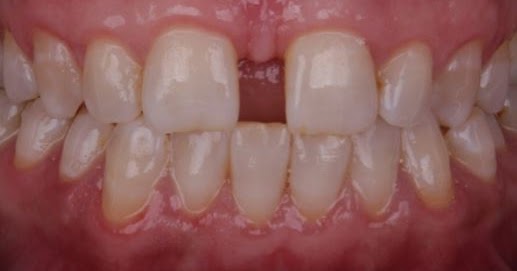 Causes of Open bite, Deep bite, crowding, Generalized spacing, Midline ...