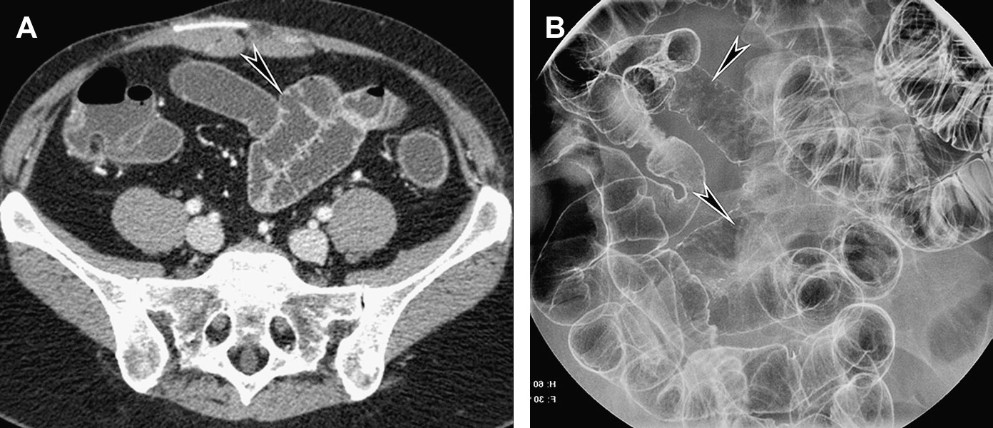 enteroclysis - USA News Collections