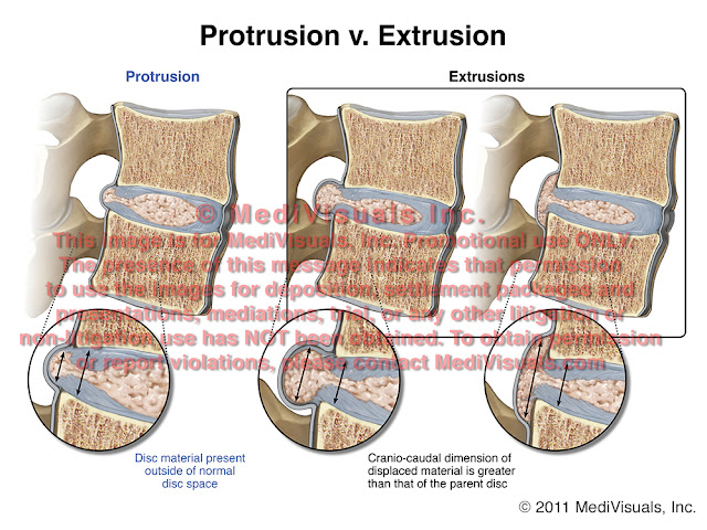 The Medical Legal Exhibit Expert Blog: Protrusions Versus Extrusions ...
