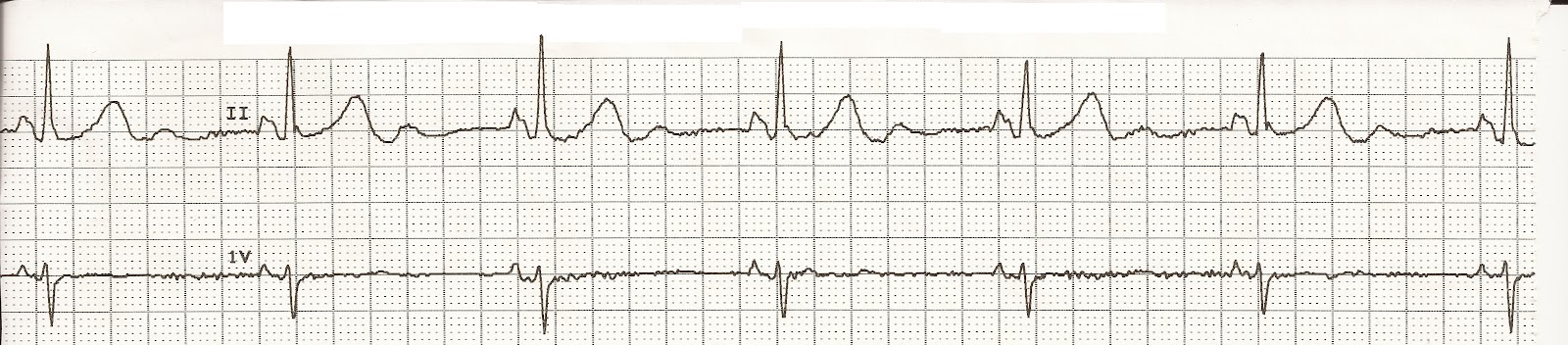 EKG Rhythm Strips 36