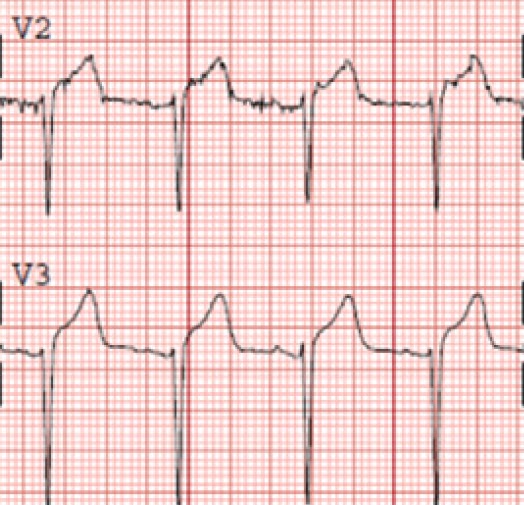 Doc Cottle's Desk: Distinguishing STEMI from LVH on the ECG