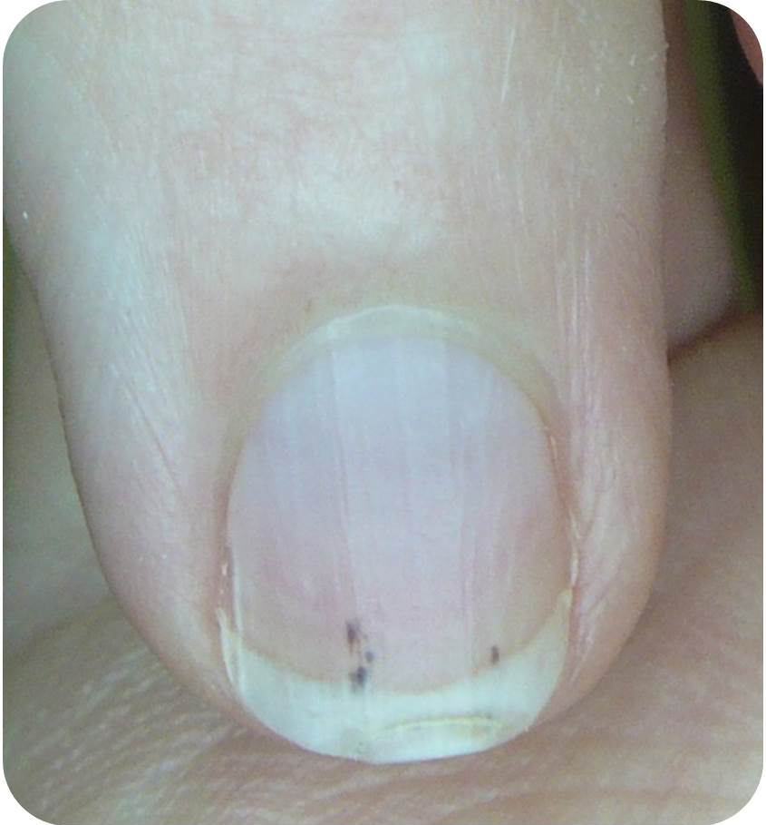 Splinter Hemorrhages Eye