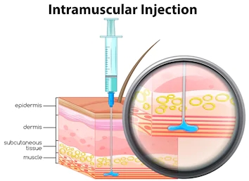 nursing study notes: Intramuscular And Subcutaneous Injection
