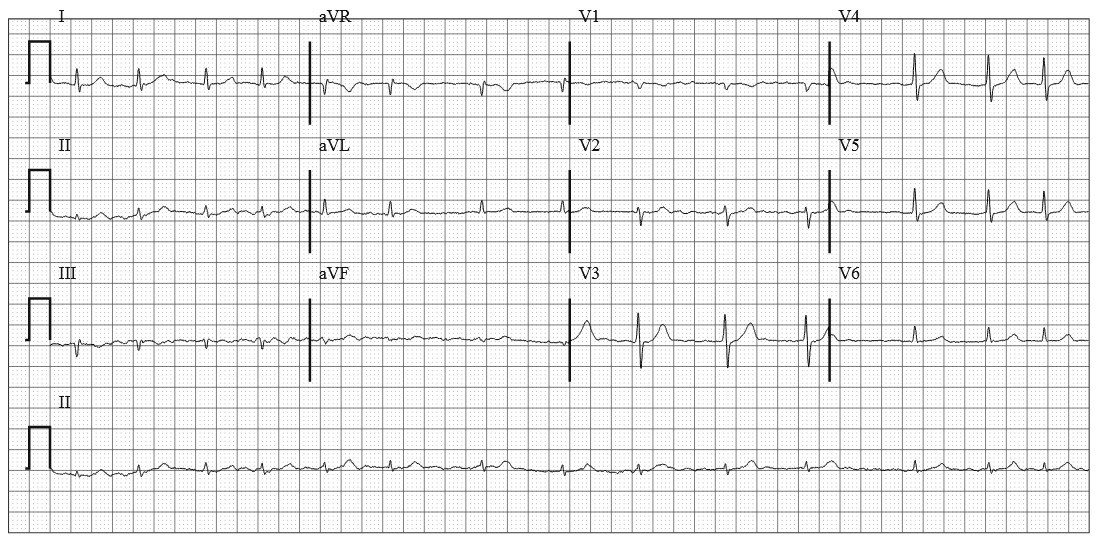 A 60 year old asymptomatic man with ECG as part of pre-operative assessment