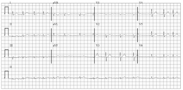 A 60 year old asymptomatic man with ECG as part of pre-operative assessment