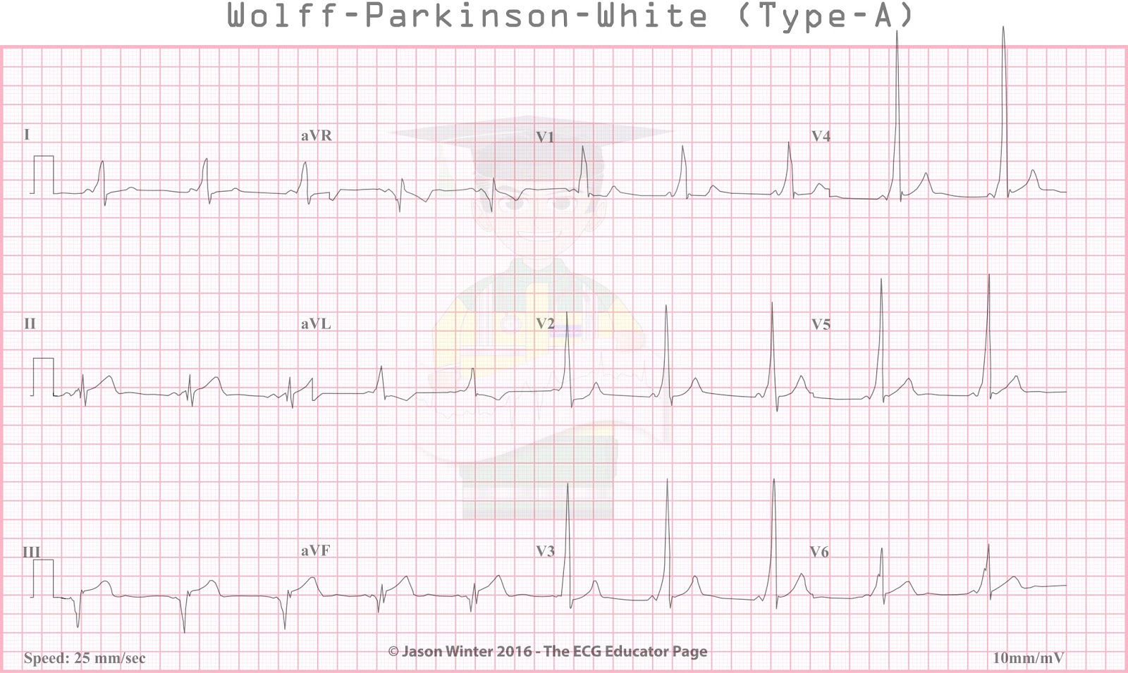 ECG Educator Blog : Wolff-Parkinson-White