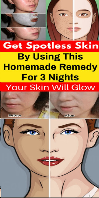 Get Spotless Skin By Using This Homemade Remedy For 3 Nights! Your Skin ...
