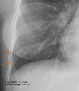 Chest Section: 5-3-Diffuse reticular pattern:
