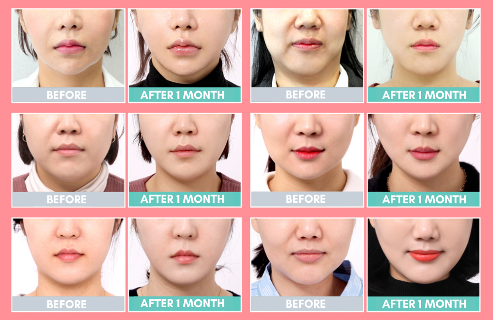 Nana Dermatology #2: HIFU laser treatments - Shurink vs. Ulthera!