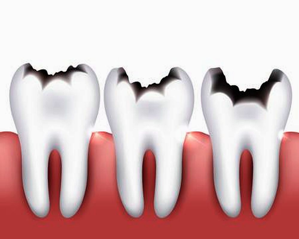 ¿Extracción dental o pulpectomía en dientes temporales? - OdontoVida