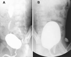 ENFERMEDADES INTESTINALES INFLAMATORIAS: 11_06
