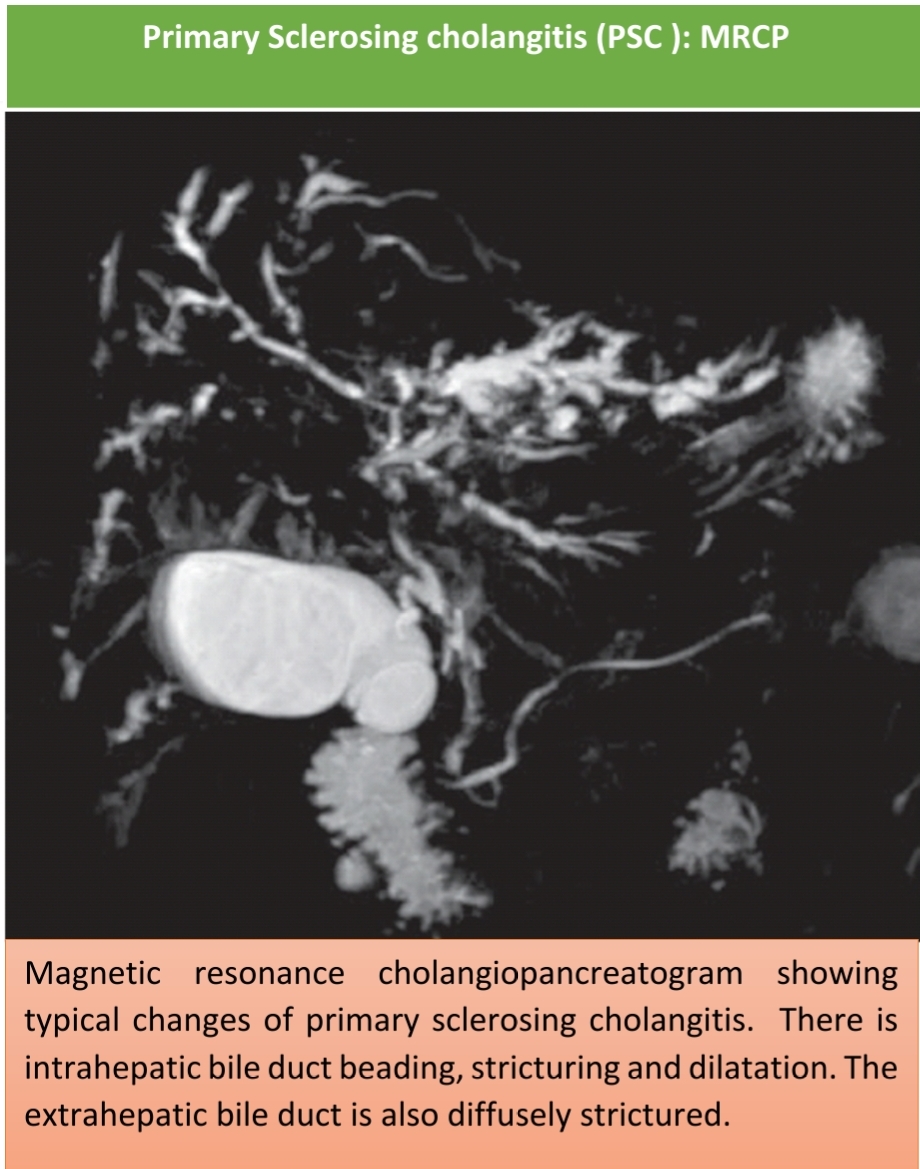 What is Primary Sclerosing cholangitis (PSC )?
