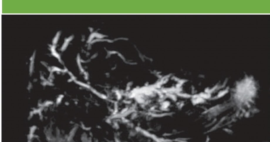 What is Primary Sclerosing cholangitis (PSC )?