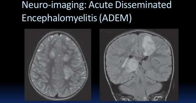 Acute disseminated encephalomyelitis