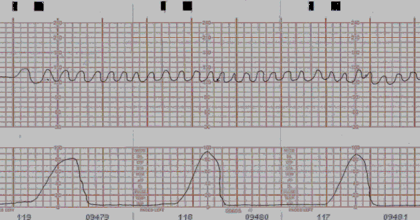 ObGyne Short Notes: What is the sinusoidal pattern (CTG)?