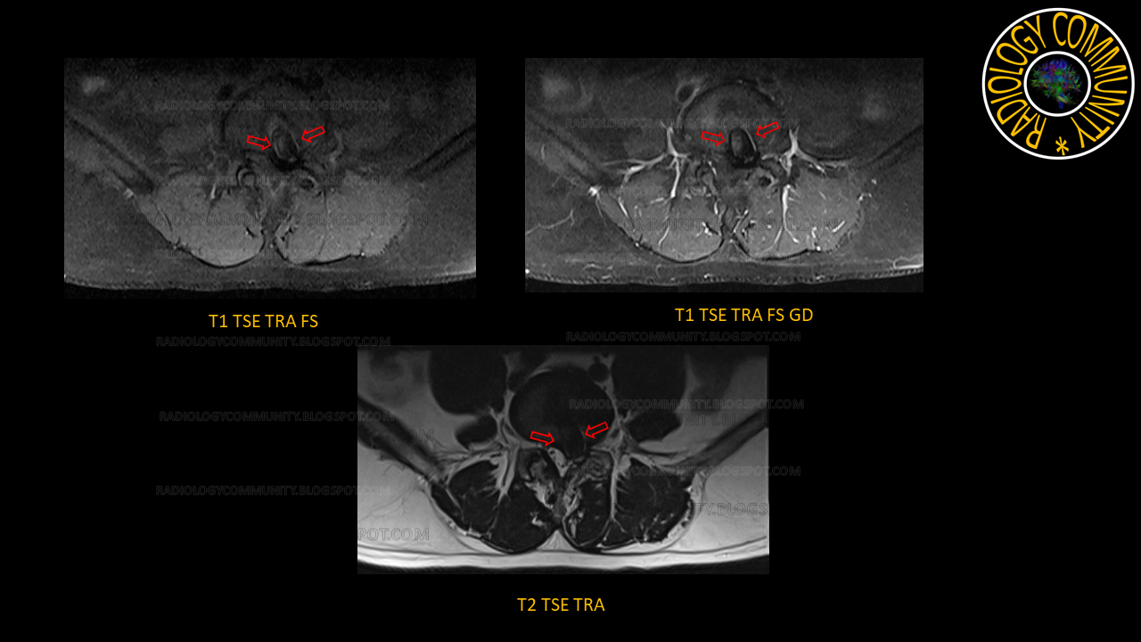 Radiology Community: Μεταλλικό εμφύτευμα στο Ο4-Ο5 δίσκο της ΟΜΣΣ