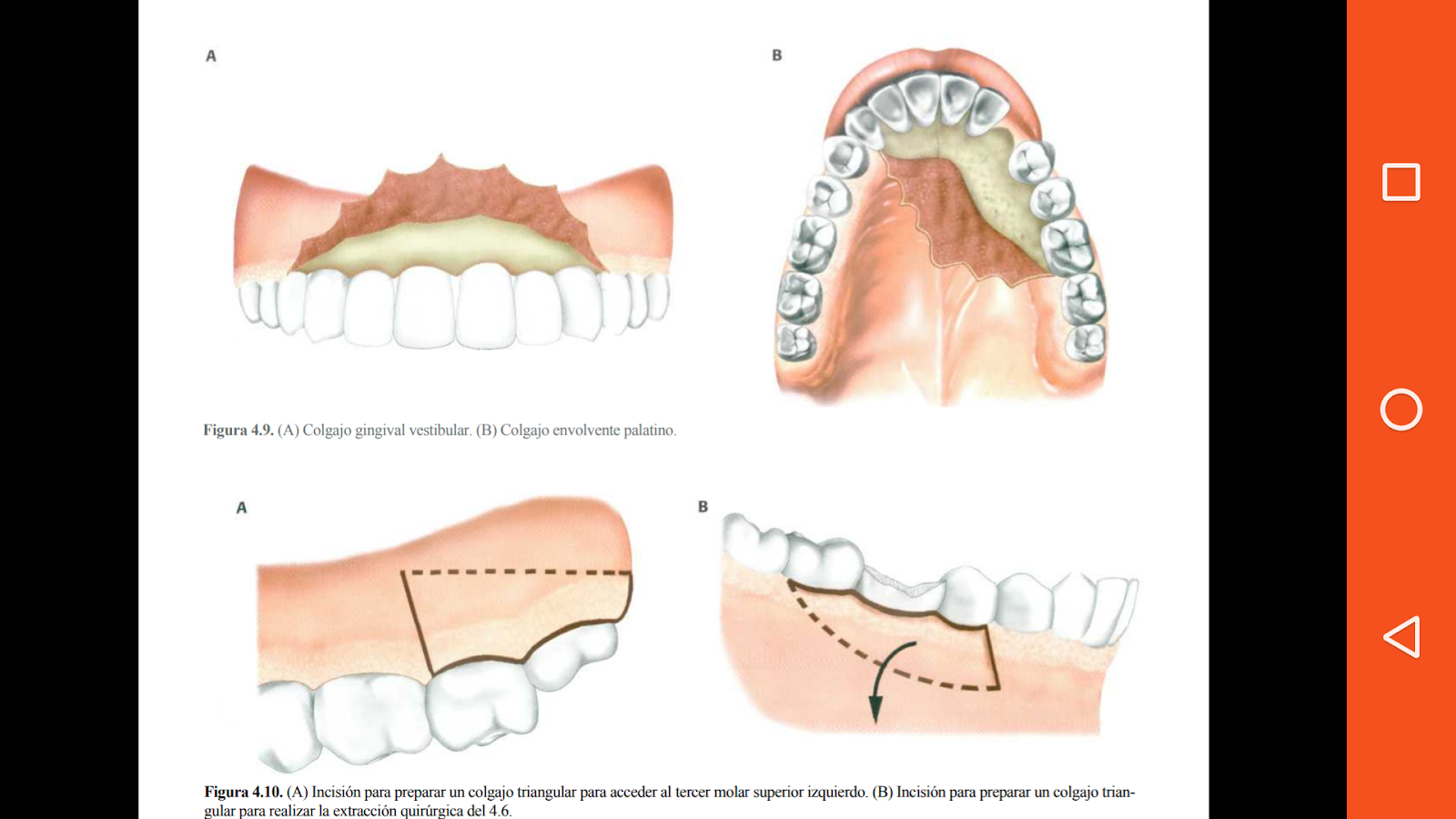 FUNDAMENTOS DE ANESTESIA Y EXODONCIA : INCISIONES Y SUTURAS