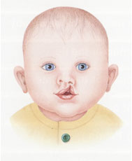 Motricidad Orofacial : Fisuras