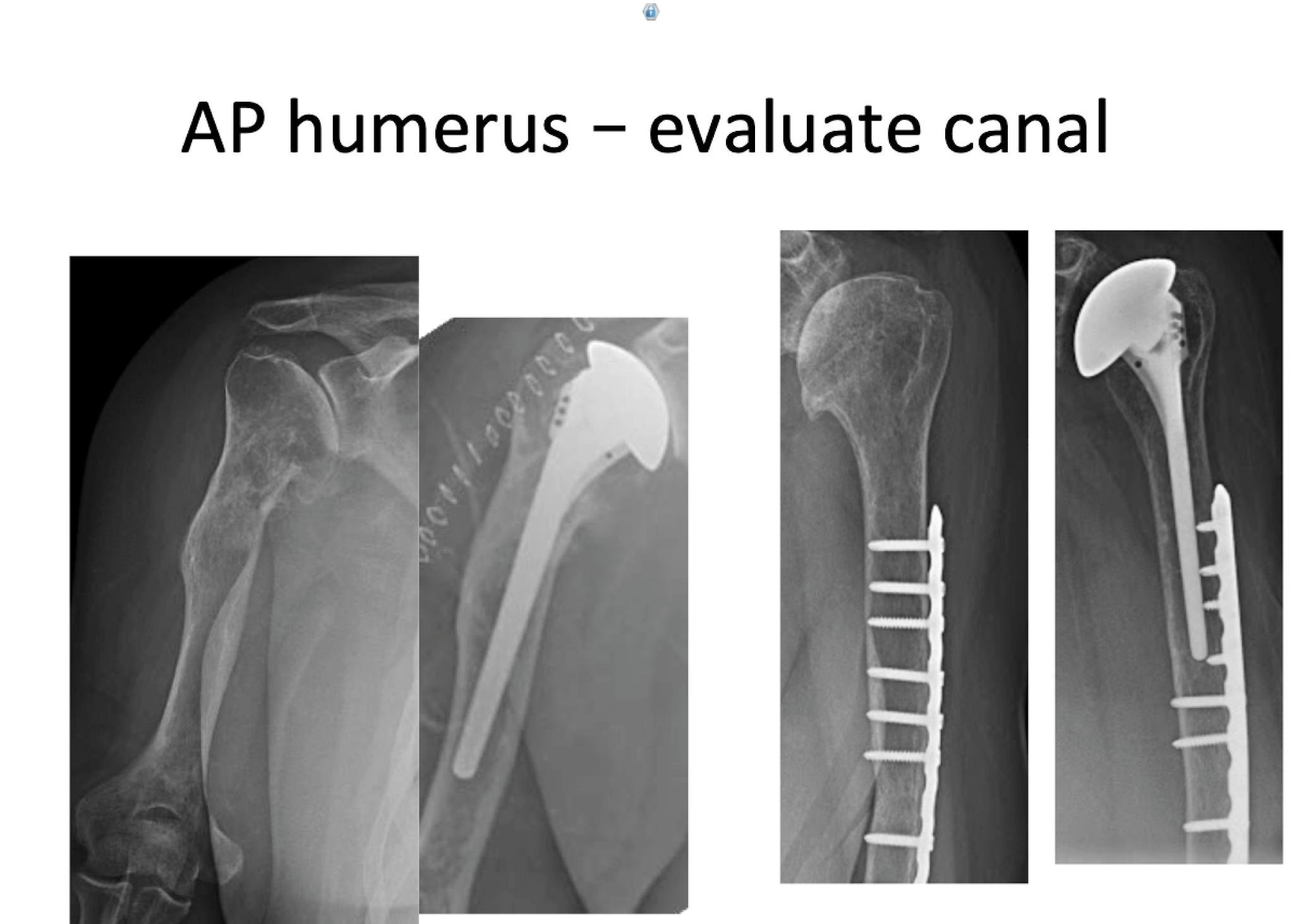 UW Shoulder and Elbow Academy: Ream and run - imaging the shoulder ...