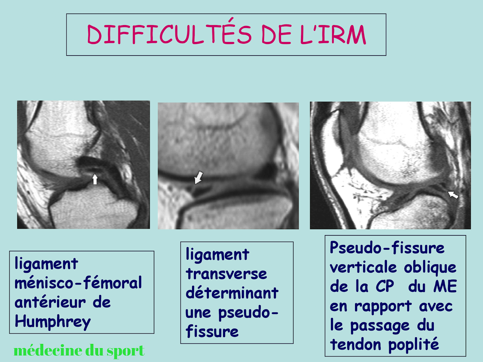 IMAGERIE DU GENOU APPLIQUÉE A LA PATHOLOGIE SPORTIVE