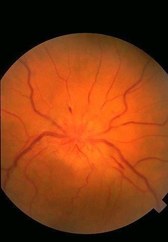 Sanatatea este Vitala: Nevrita optică