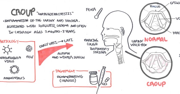 CLINICAL CASE PRESENTATION -CROUP