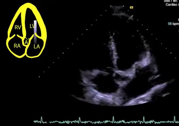 Learn Echocardiography | Standard Protocol for Performing Comprehensive ...