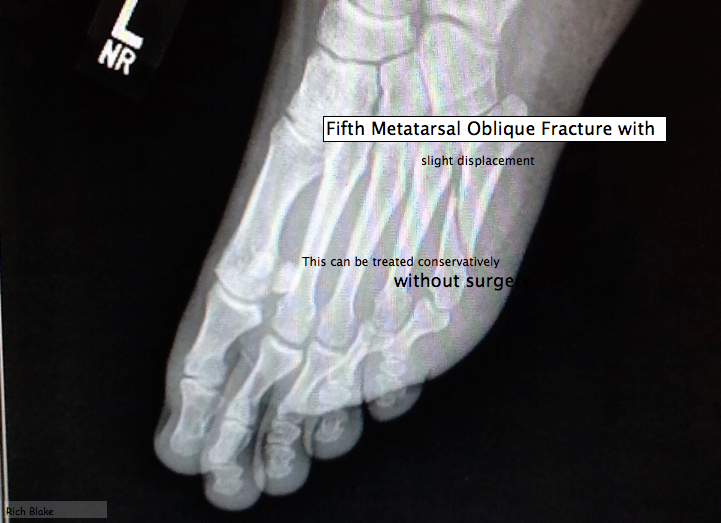 Foot and Ankle Problems By Dr. Richard Blake: Fifth Metatarsal Oblique ...