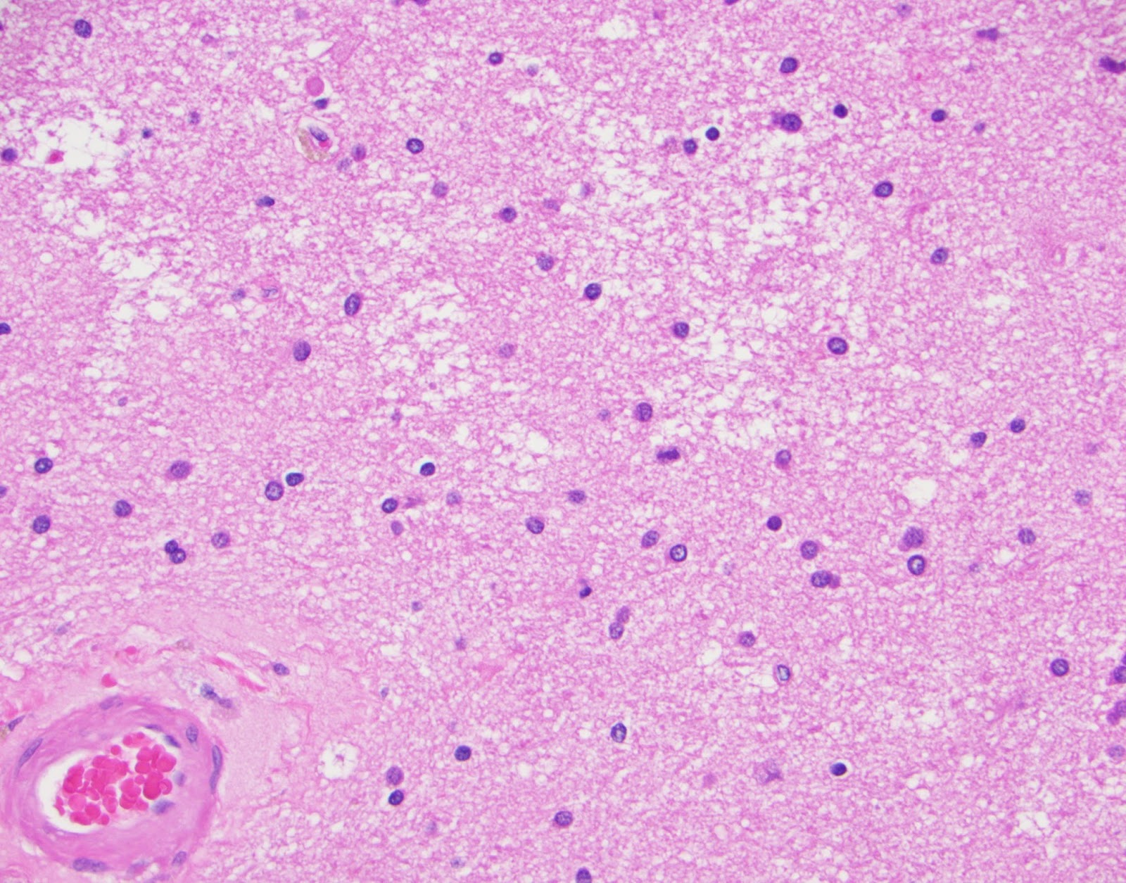 neuropathology blog: Best Post of November 2015: A 60-year-old woman ...