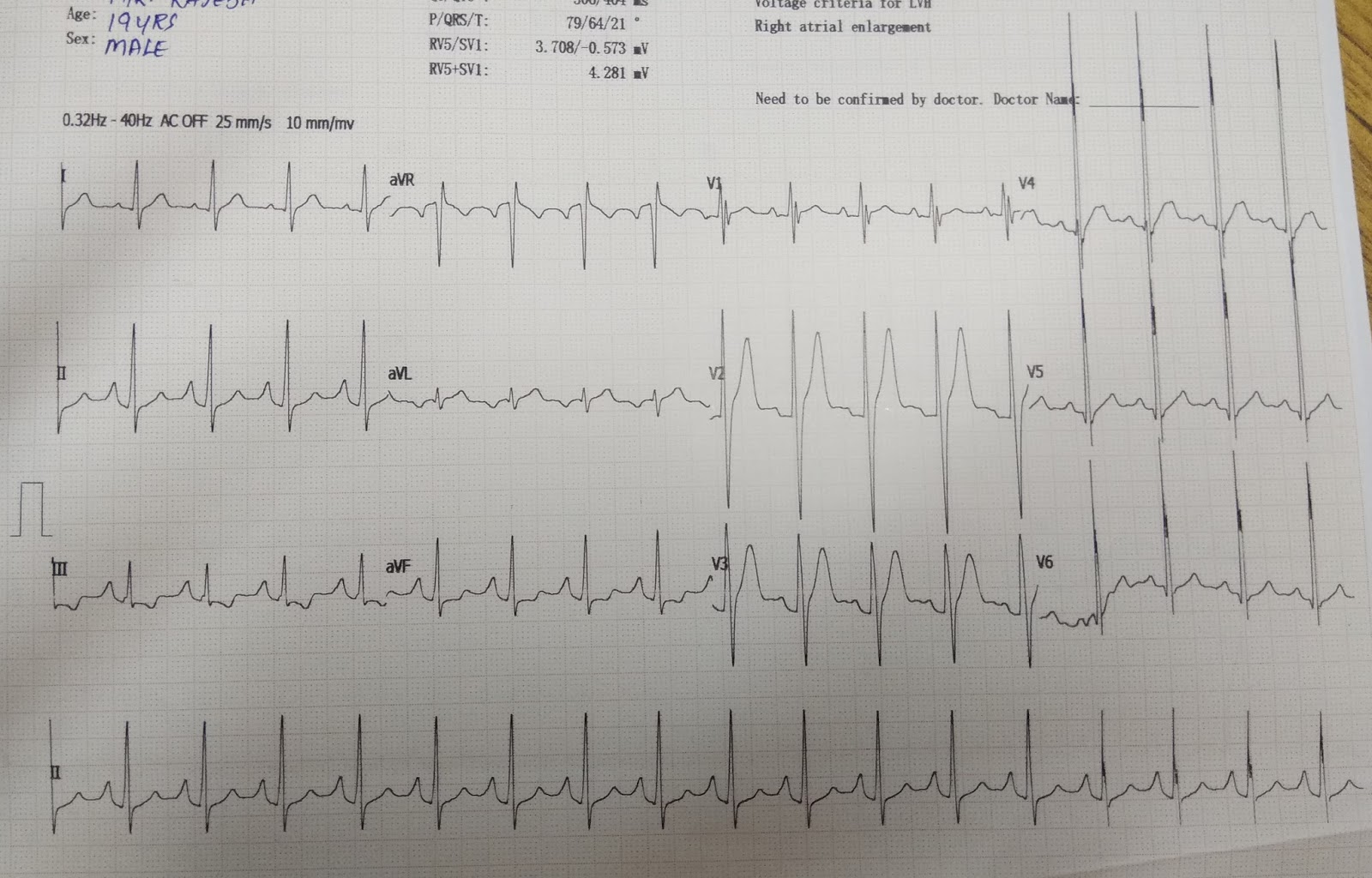 Cardiology window: WPW syndrome, left posterior pathway, intermittent ...