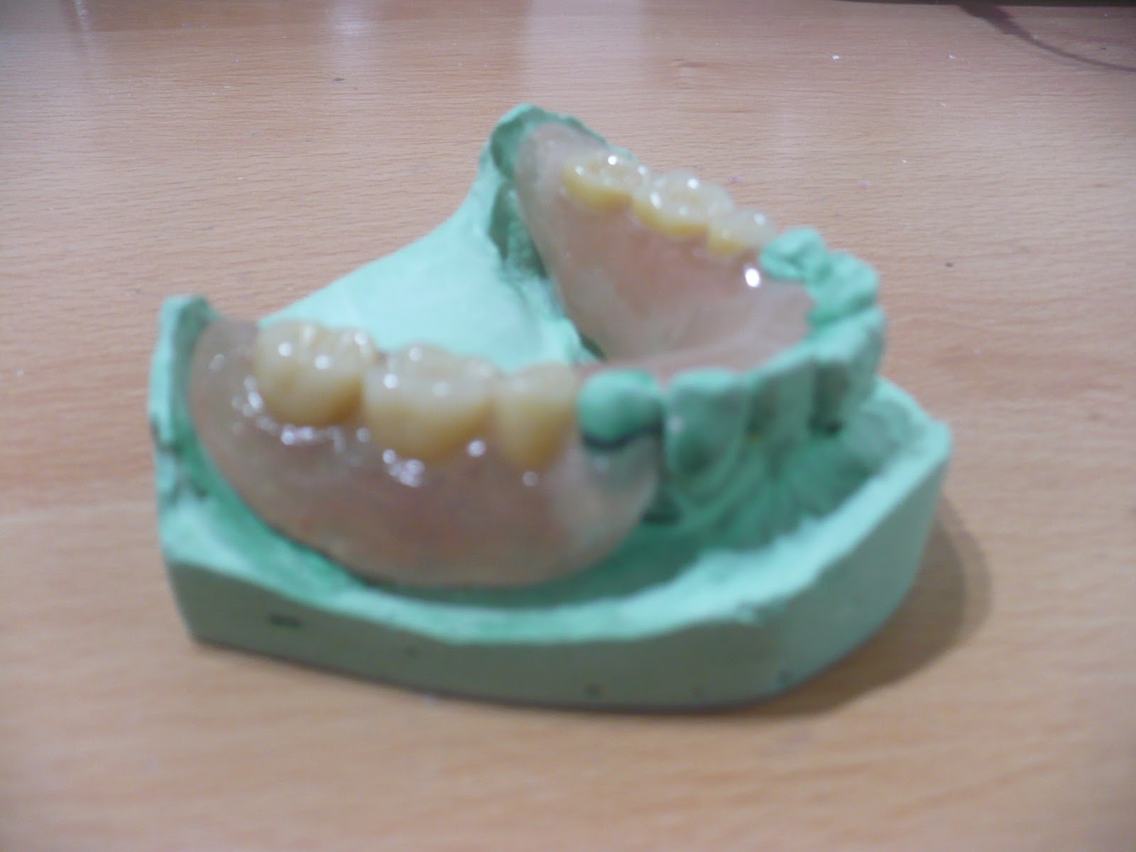 Laboratorio Dental Fernando Emmanueli: Protesis Parcial Deflex