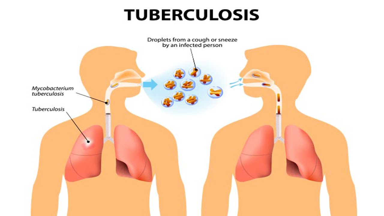 Enfermedades infecciosas: CAUSAS Y FACTORES DE RIESGO DE LA TUBERCULOSIS