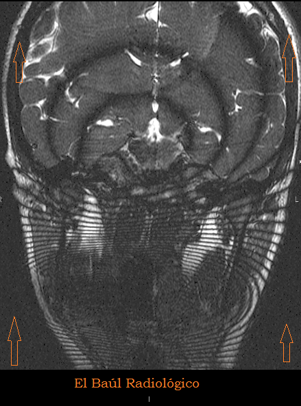 El Baúl Radiológico: ARTEFACTOS EN LAS SECUENCIAS DE ECO DE GRADIENTE ...