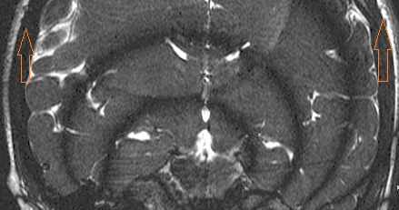 El Baúl Radiológico: ARTEFACTOS EN LAS SECUENCIAS DE ECO DE GRADIENTE ...