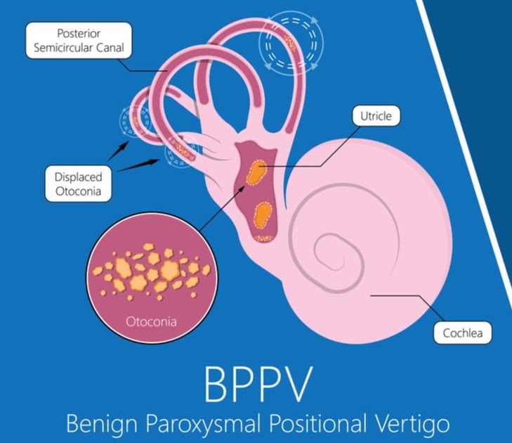 What is BPPV & How do you treat it? | Vertigo and Ear clinic