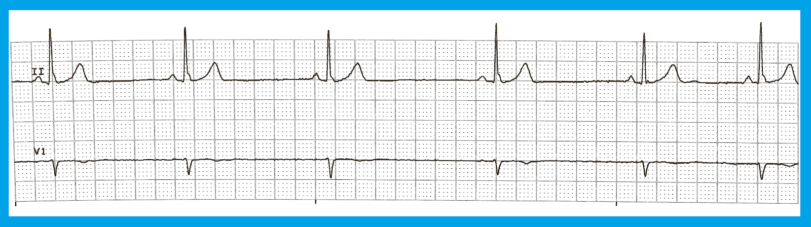 Various Sinus Arrhythmias