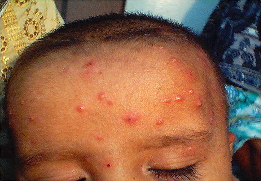 BACTERIAL INFECTION | Geoffrey E. Reed life