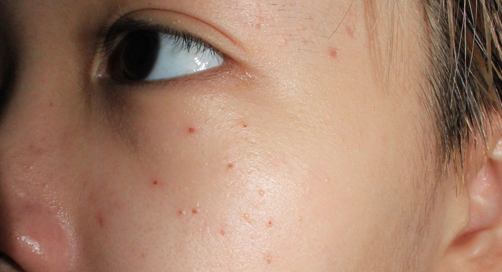 Milia Removal with Ido's Skin Center - Stella Lee ☆ Indonesia Beauty ...