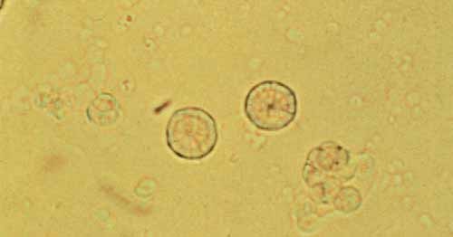 Leucine In Urine Maple Syrup Urine Disease Screening | Colorimetric