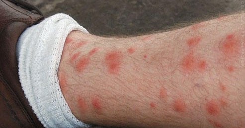 Lower Leg Rashes and the Cause