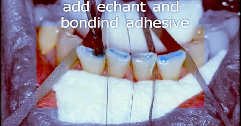 INCISAL EDGE REINFORCEMENT: Technique step by step - Dr. Buddy Mopper ...