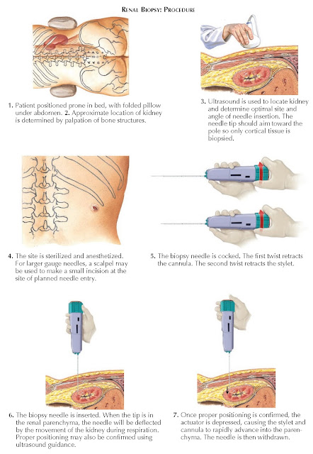 RENAL BIOPSY - pediagenosis