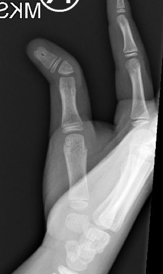 Two different thumb birth differences | Congenital Hand and Arm ...