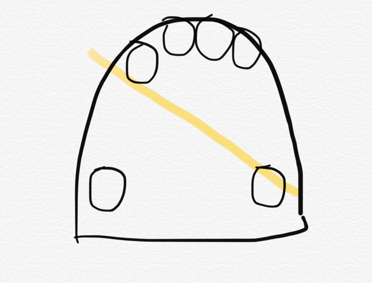 Dentowesome: Fulcrum Lines in RPD
