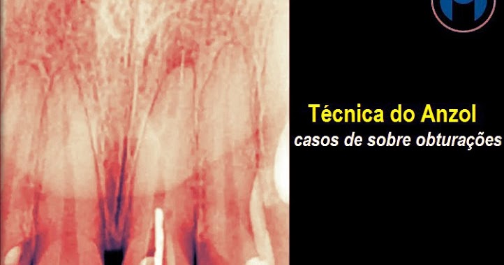 ENDODONTIA: Técnica do Anzol - casos de sobre obturações - Odonto-Tv