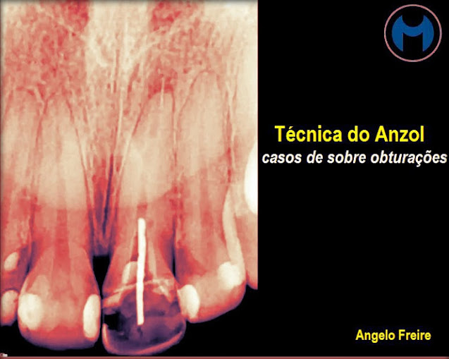 ENDODONTIA: Técnica do Anzol - casos de sobre obturações